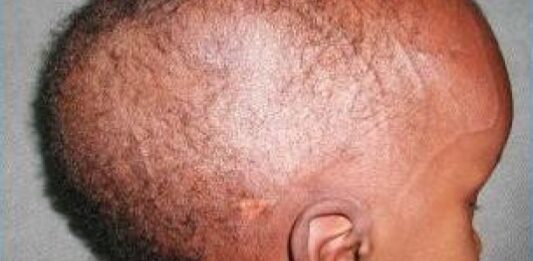 Neurochirurgie du CHU de Fann : Une mission prend en charge des enfants ...